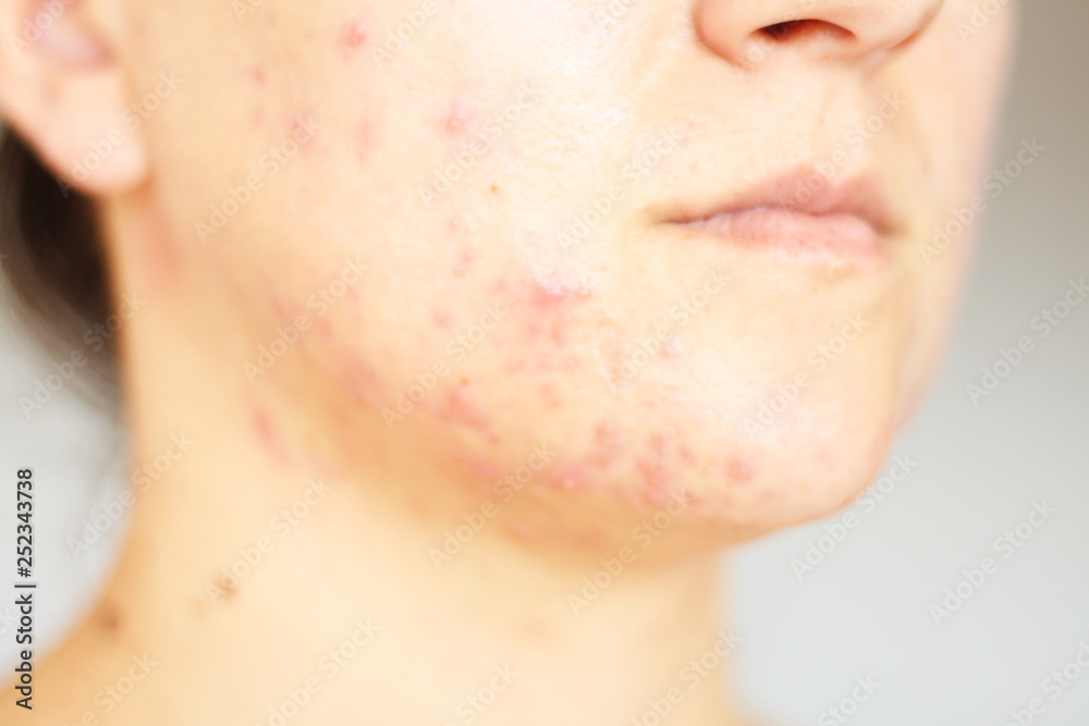 Acne on the face of young women. Improper therapy has led to a severe ...