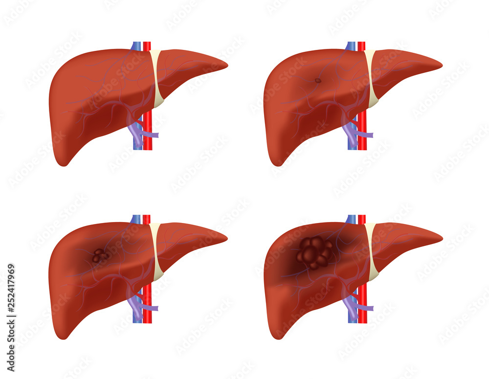 liver cancer stages vector / tumor Stock Vector | Adobe Stock