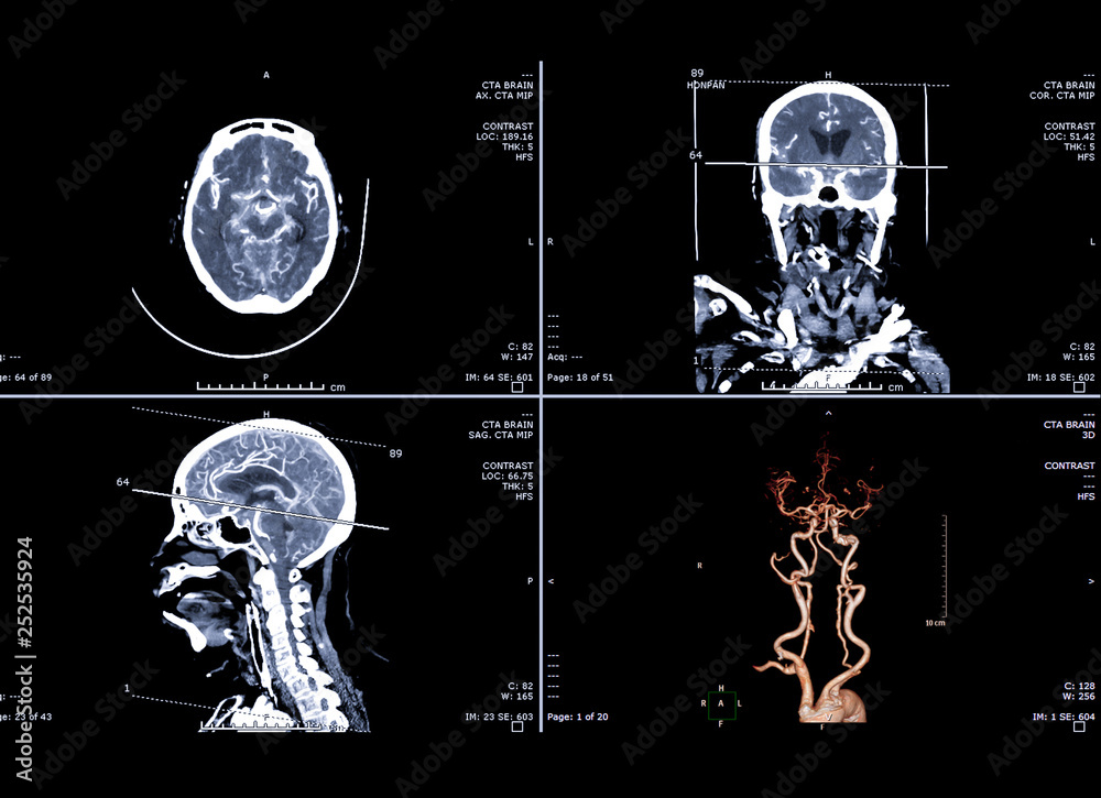 Computed tomography angiography or CTA brain 3D Rendering image ...