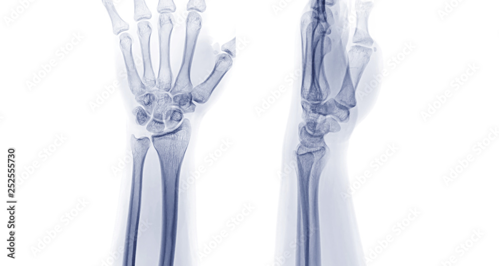 X Ray Wrist Ap
