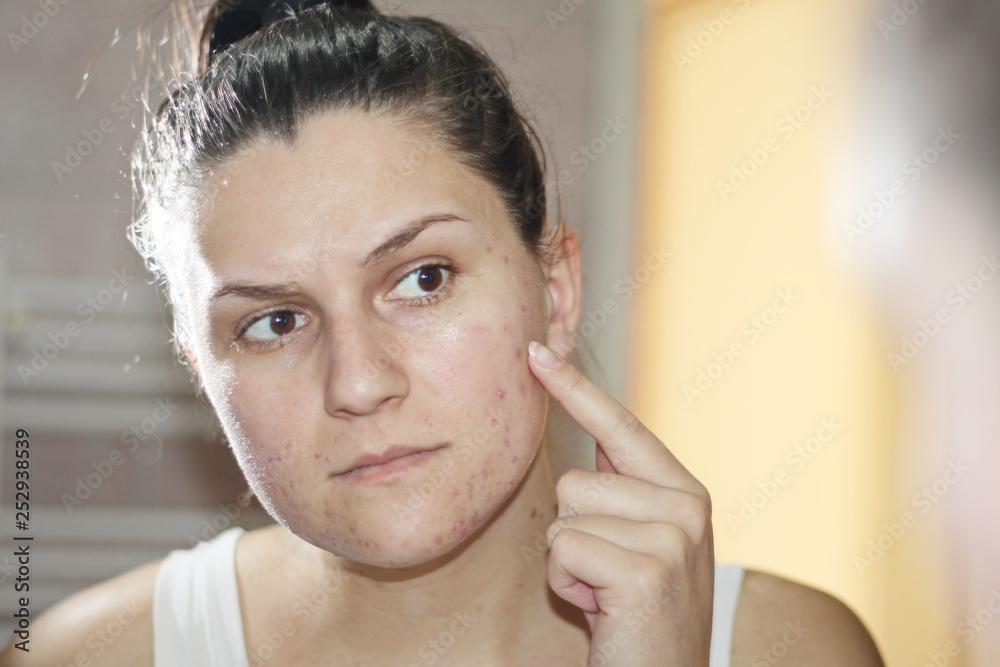 Acne on the face of young women. Improper therapy has led to a severe ...