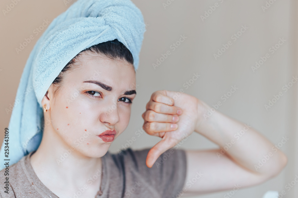 Scowling girl in shock of her acne with a towel on her head. Woman skin ...