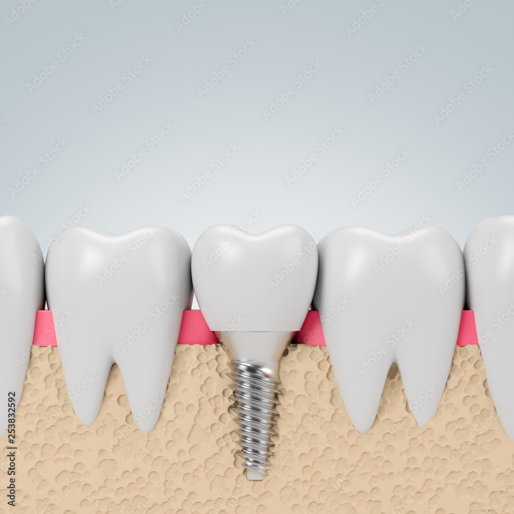 Teeth with implant screw, gray background Stock Illustration | Adobe Stock