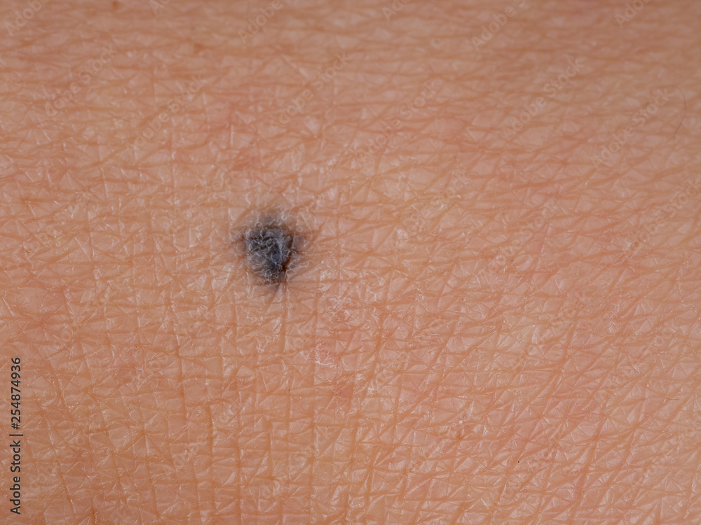 Dark colour Blue neuronevus mole aka dermal melanocytoma, a type of ...