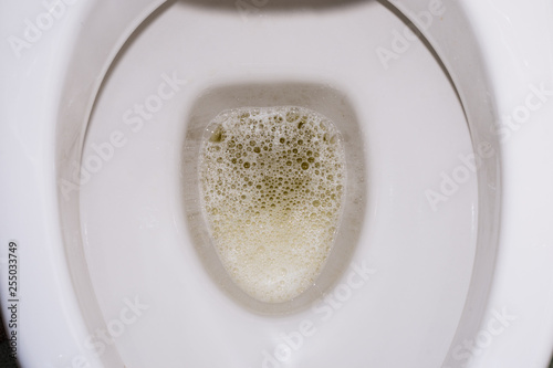 Frothy bubbly urine in the toilet bowl. Kidney disease. Protein ...