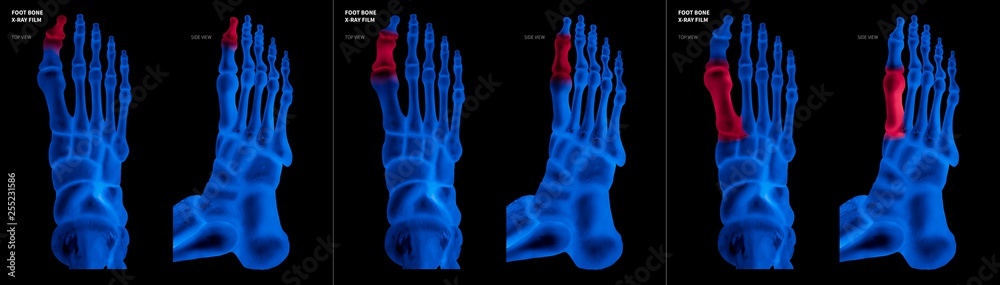 X-ray blue film collection of Big toe foot bone with red highlights on ...