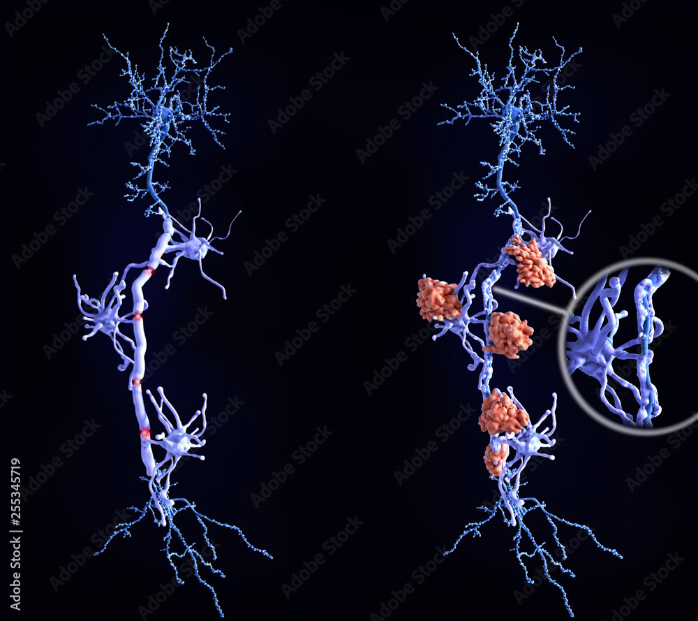 Multiple sclerosis (MS): heatlhy neuron with intact myelin sheaths ...