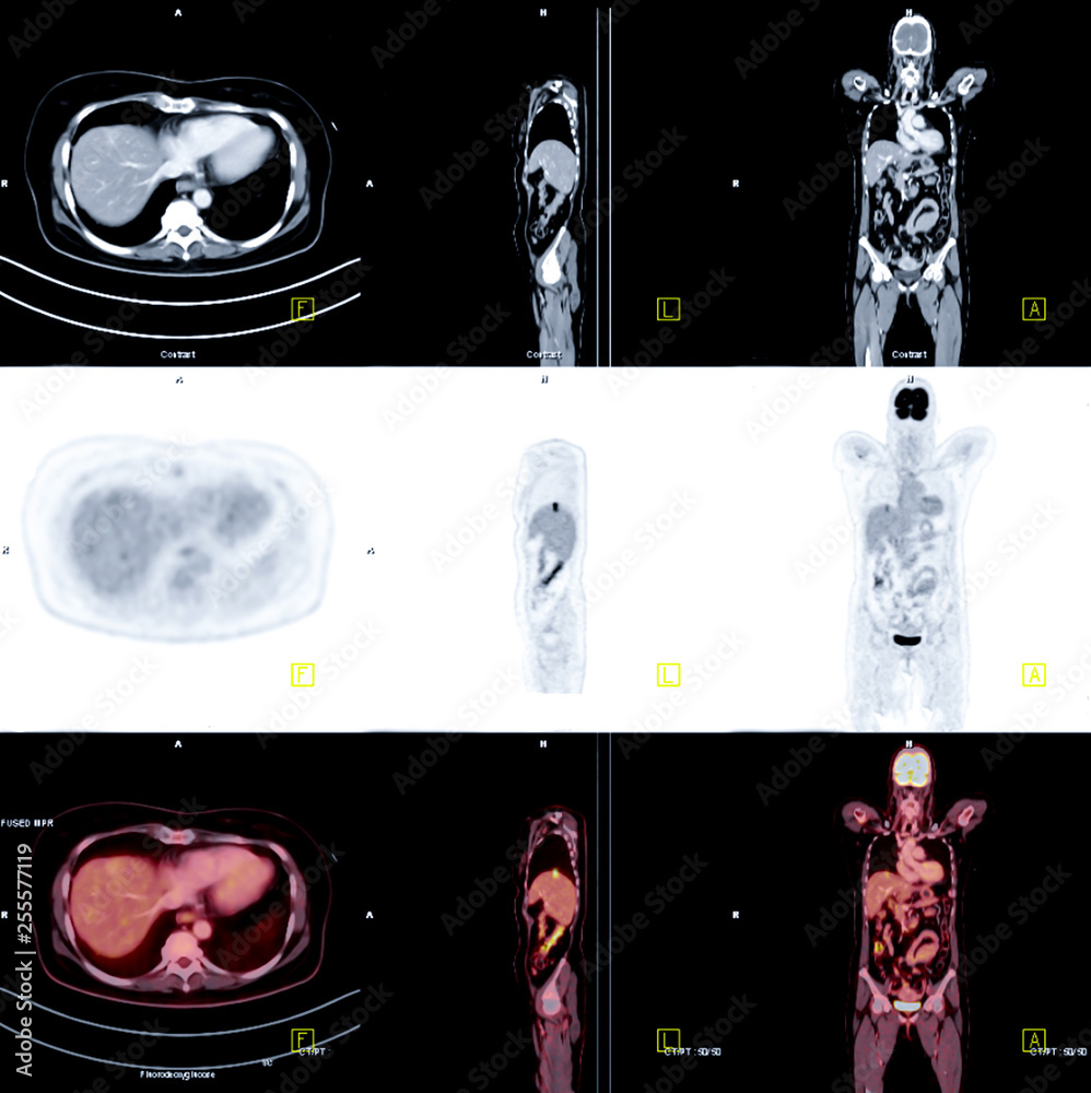 Foto Stok PET Scan image of whole body Comparison Axial , Coronal and Sagittal plane for finding ...