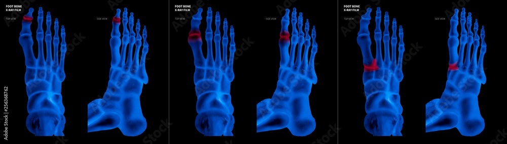 Ilustração X-ray of collection arthritis big toe joint foot bone red ...
