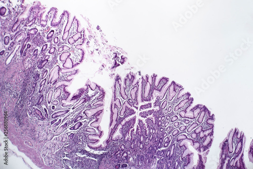 Histopathology of chronic superficial gastritis, light micrograph ...
