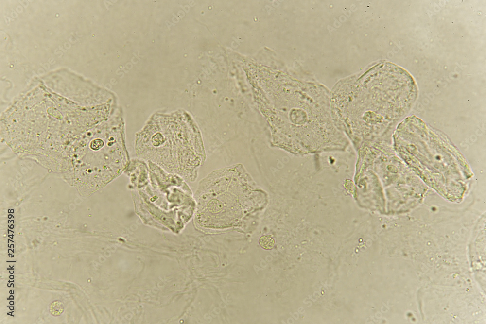 Epithelial cells with bacteria in patient urine, urinary tract ...