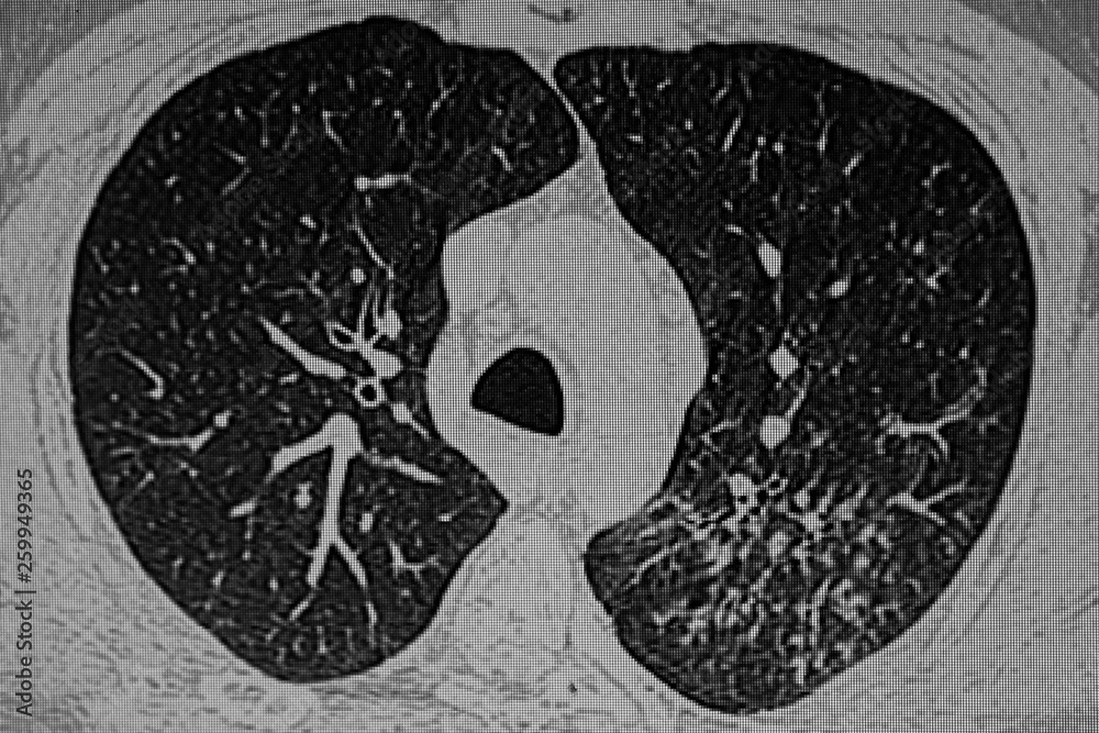 Pulmonary Tuberculosis CAT (Computer Axial Tomography) Stock Photo ...