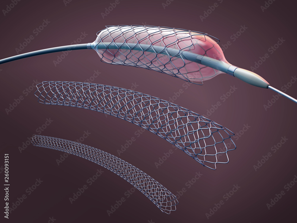 Three metal stents for implantation and supporting blood circulation ...