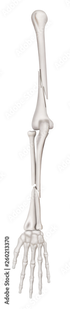 Ulna- Radius and Humerus Fractures or Broken Arms completed displaced ...
