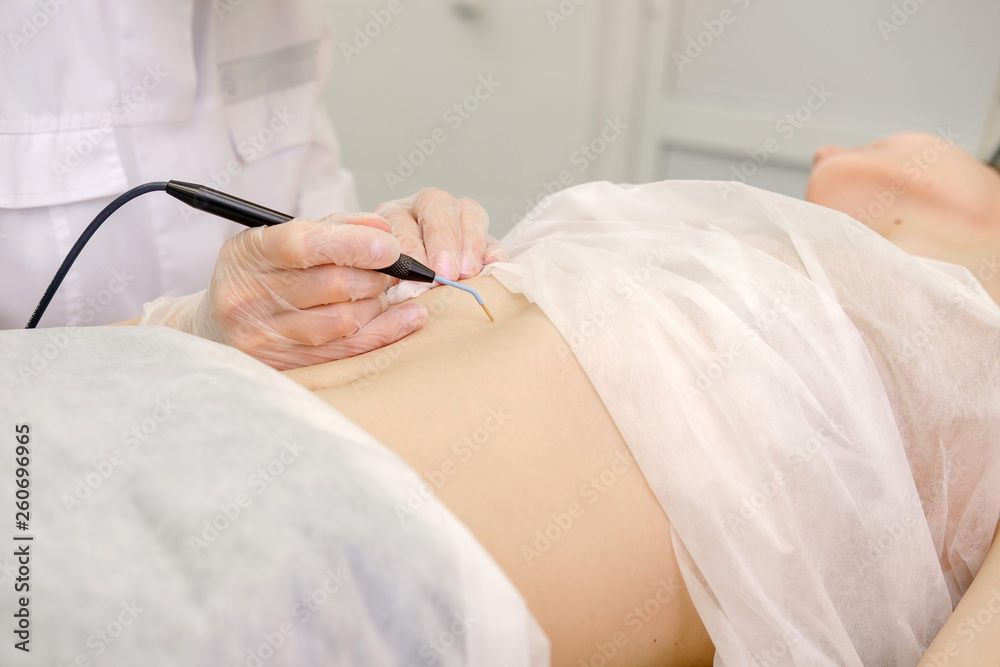 Medical treatment removal of birthmark from female patient's stomach ...