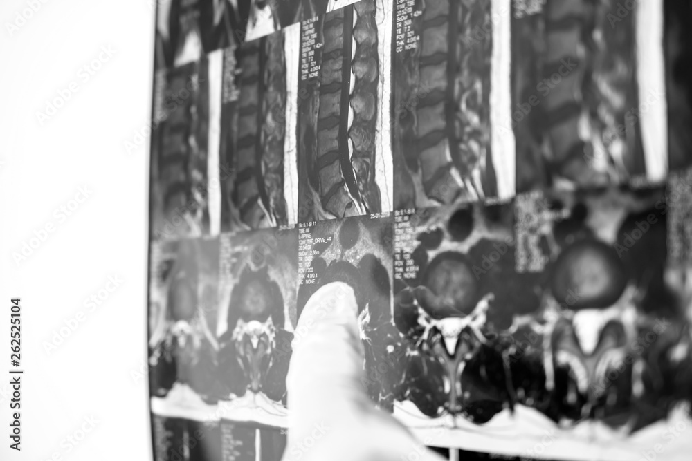 Magnetic resonance tomography (MRT) of the lumbar spine. Hernia of the ...