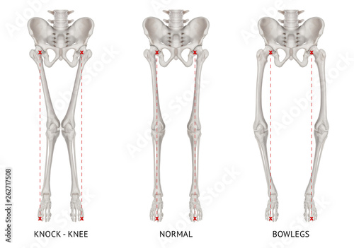 Alignment types disease leg bone problem of knock knee -Normal and ...