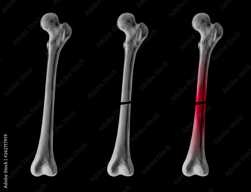 Stock-Foto „Collection of Broken bone or Bone Fractures completed ...