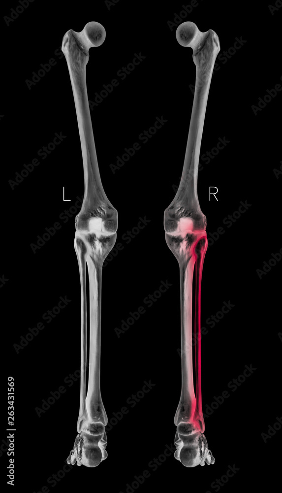 X-ray of Human Leg bone left and right- Posterior view red highlights ...