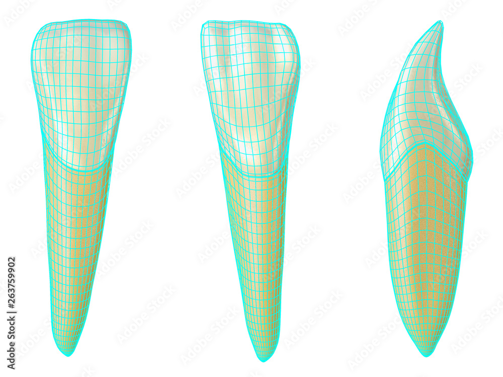 mandibular lateral incisor tooth in the vestibular, palatal and lateral ...