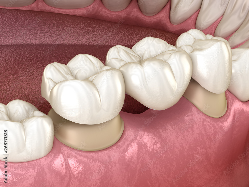 Dental bridge of 3 teeth over molar and premolar. Medically accurate 3D ...