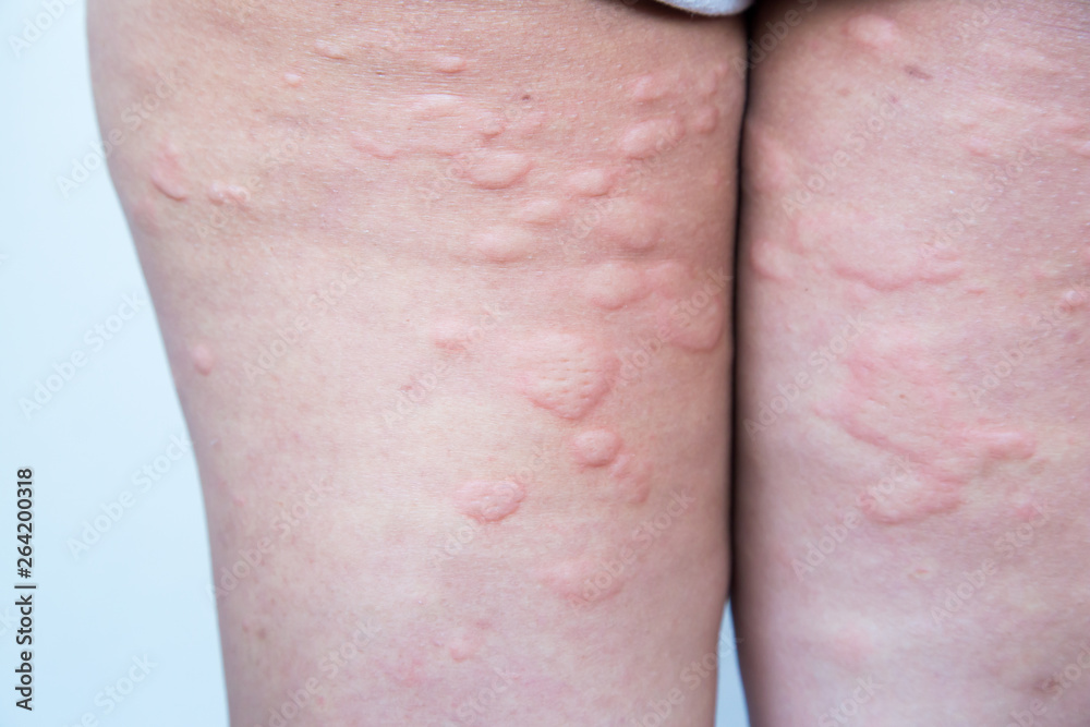 Skin rash in the legs Stock Photo | Adobe Stock