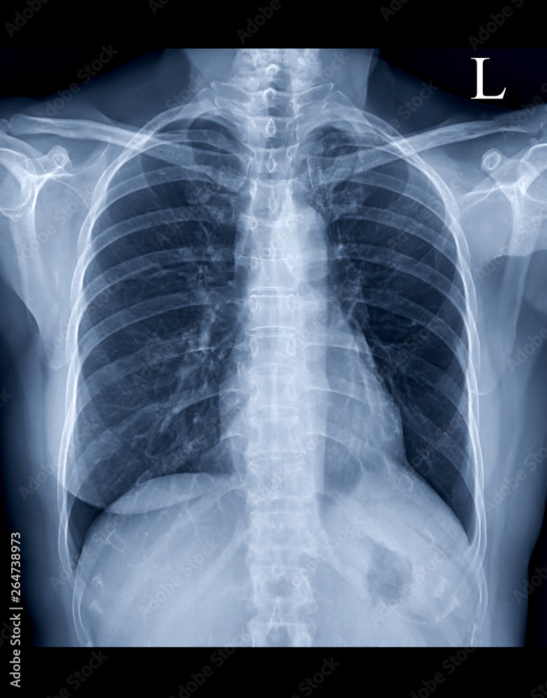 Chest X-ray or X-Ray Image Of Human for detect heart disease and lung ...