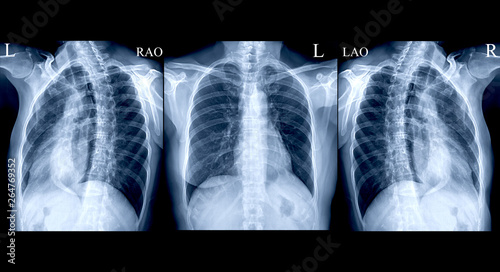collection Chest X-ray or X-Ray Image Of Human AP and both oblique view ... collection Chest X-ray or X-Ray Image Of Human AP and both oblique view ...
