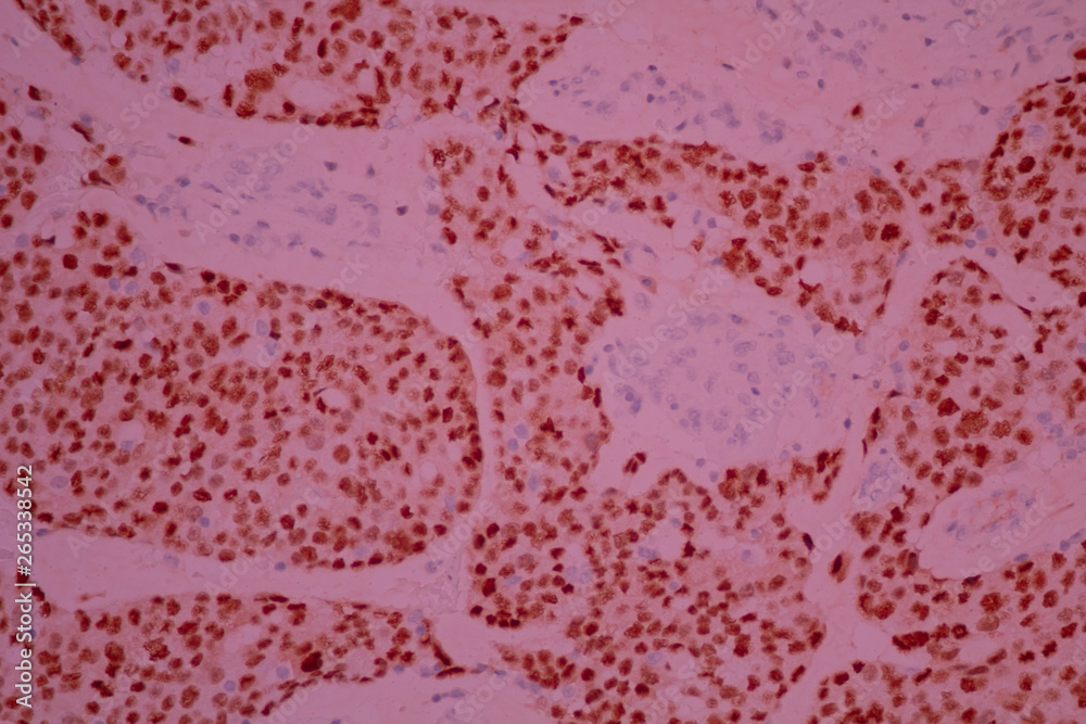 View in microscopic pathology section of immunohistochem stain hormone ...