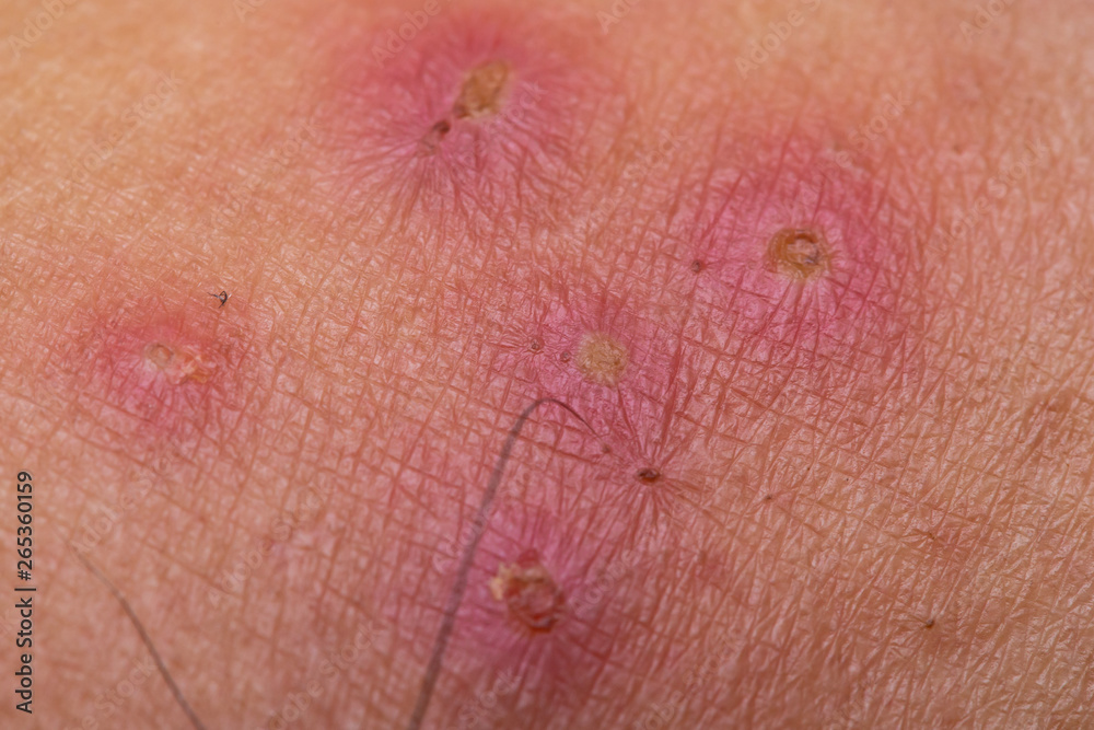 Wound infection on the skin, Skin lesions, Impetigo, Ecthyma, Pressure ...