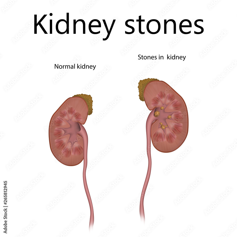Kidney stones. Normal, healthy, urolithiasis, renal lithiasis ...
