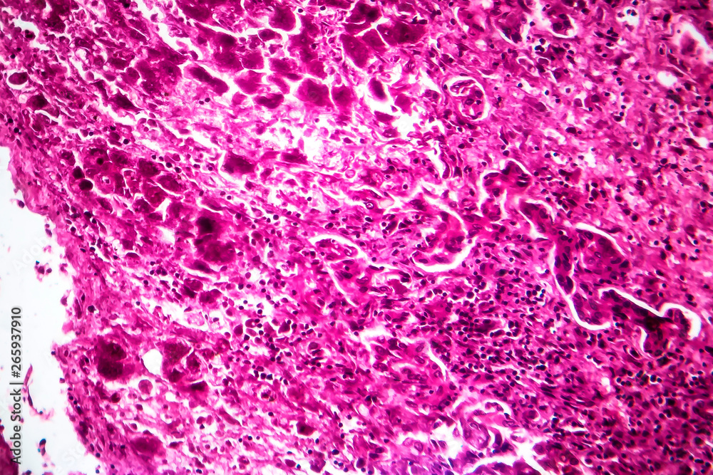 Histopathology of subacute severe hepatitis, light micrograph, photo ...