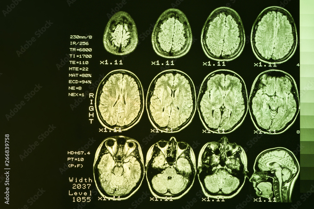 MRI scan or magnetic resonance image of head and brain scan. The result ...