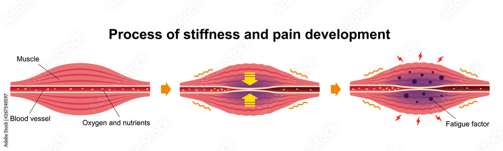 Cause of muscle's stiffness and pain illustration Stock Vector | Adobe ...