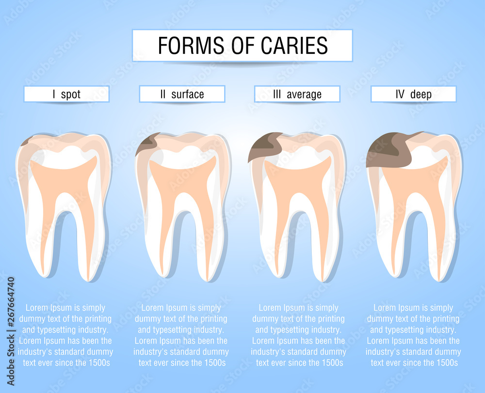 Forms of caries. Stages of development of carious process. Visual aid ...
