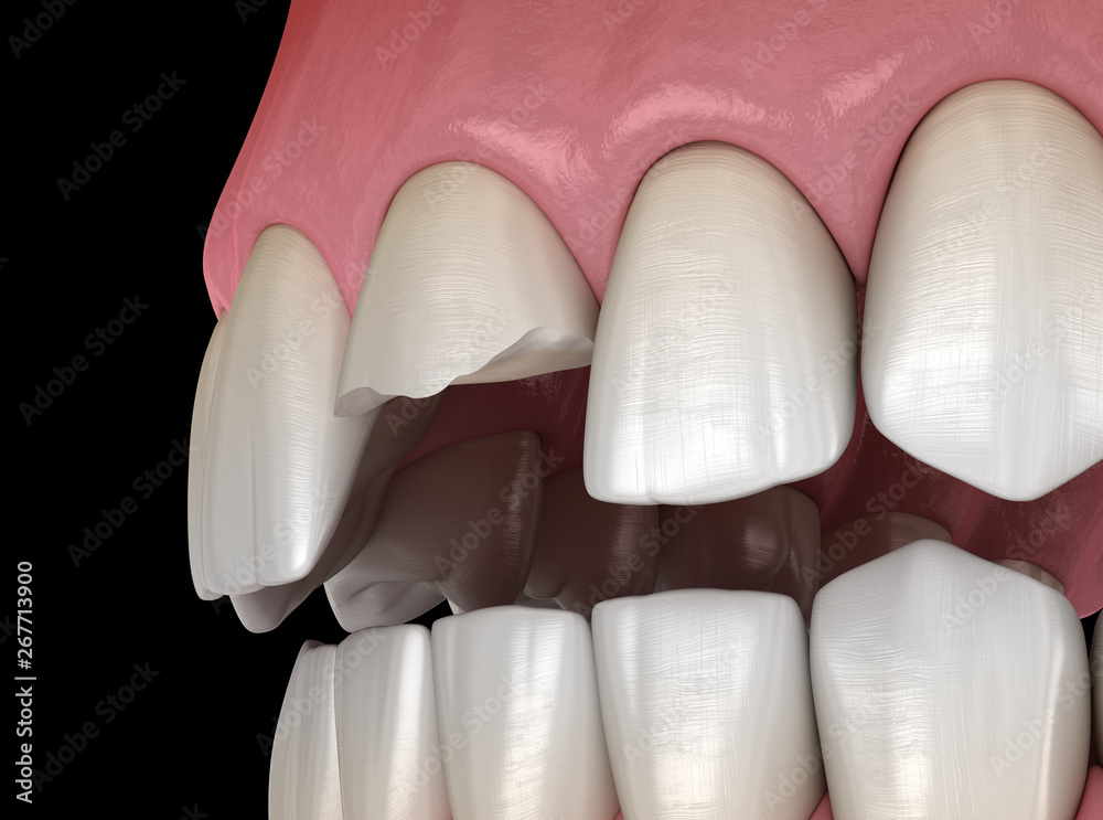 Broken central incisor tooth. Medically accurate 3D illustration of ...