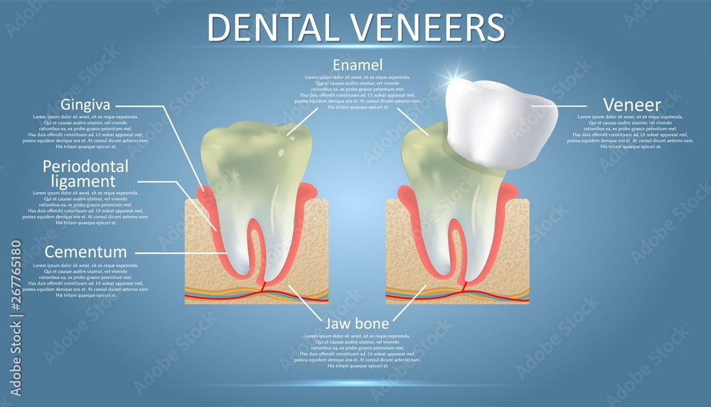 Dental veneers diagram, vector educational poster, diagram Stock Vector ...