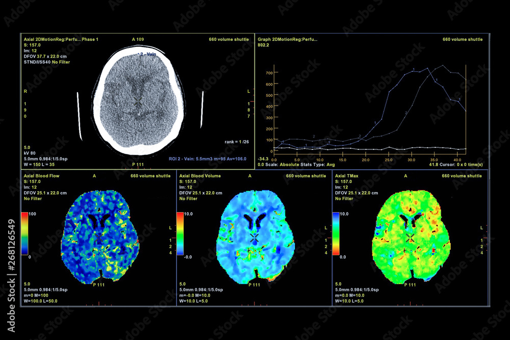 Perfusion CT scan of the brain ,The red and green and blue are areas of ...