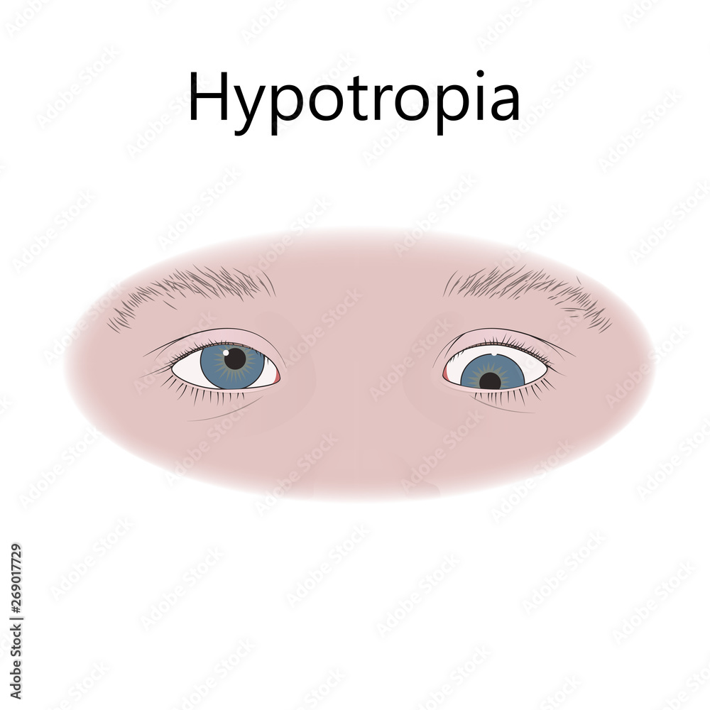 Strabismus in infants, child, kid. Hypotropia, downward eyes. Vector ...