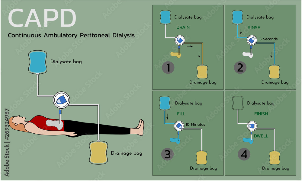 Continuous Ambulatory Peritoneal Dialysis (CAPD) , vector illustration ...