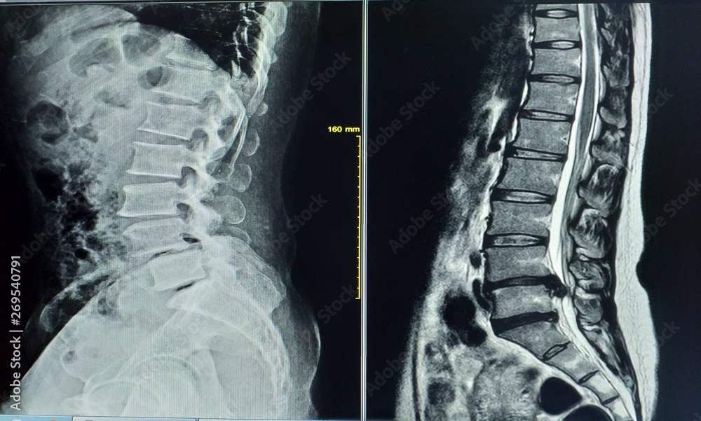 Stock-Foto „X-ray image Two views general x-ray and MRI lumbar spine ...