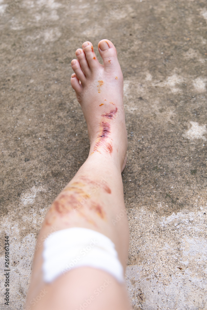 Bruise wound on woman's foot Stock Photo | Adobe Stock