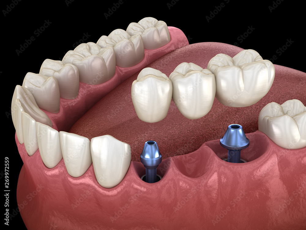 Dental bridge supported by implants. Medically accurate 3D illustration ...