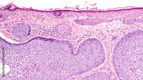 Skin biopsy pathology of basal cell carcinoma, the most most common type of sun induced skin ...