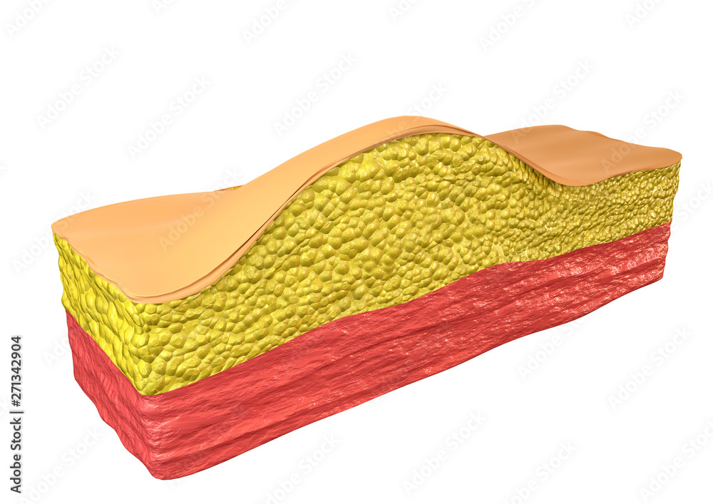 Lipoma - a benign tumor composed of adipose tissue cells (adipocytes ...