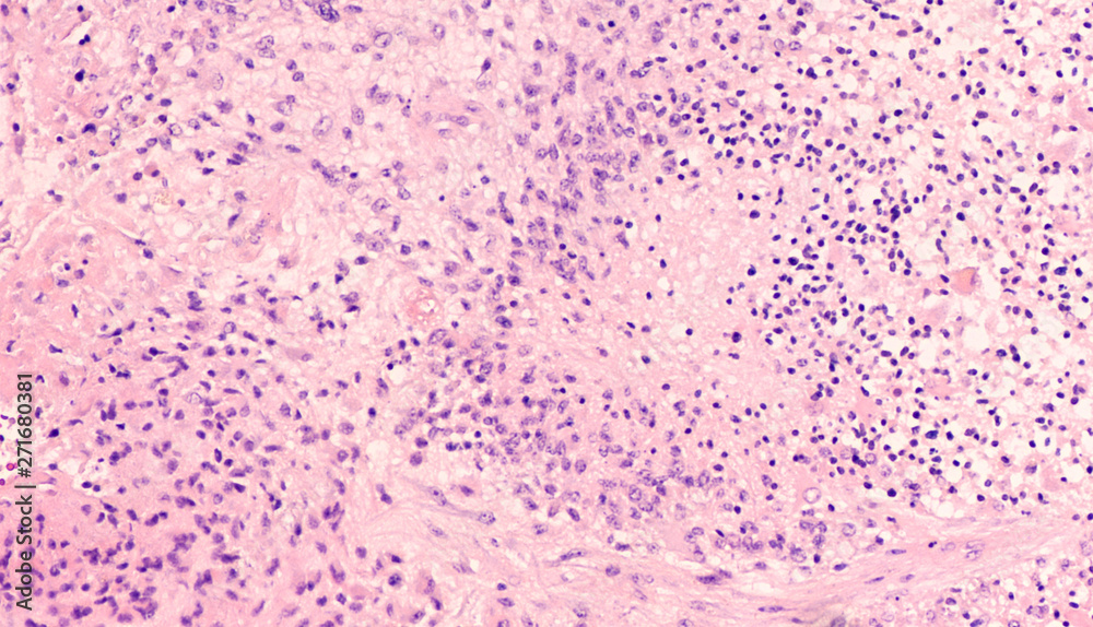 Microscopic image showing histology of a glioblastoma multiforme (GBM ...