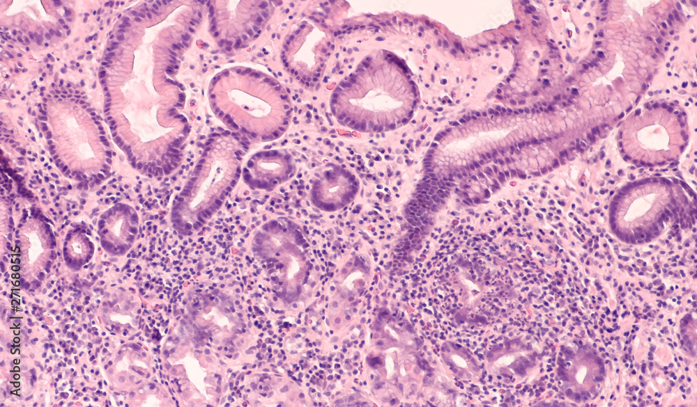 Microscopic image of an endoscopic gastric (stomach) biopsy showing ...