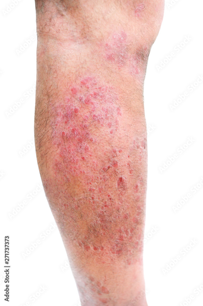 Atopic dermatitis (AD), also known as atopic eczema, is a type of skin ...
