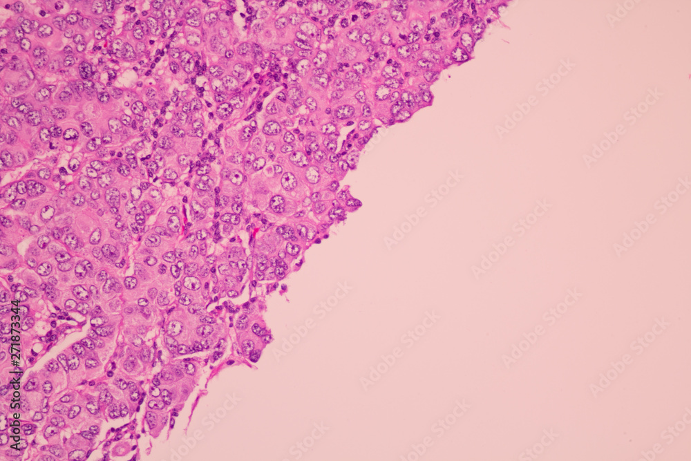 Section tissue of breast cancer view in microscopy.Ductal cell ...