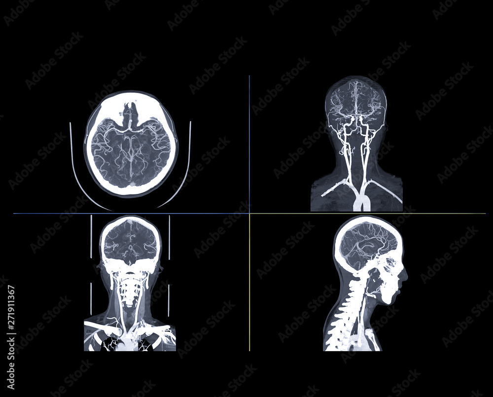 CTA brain or CT angiography of the brain comparison Coronal and ...